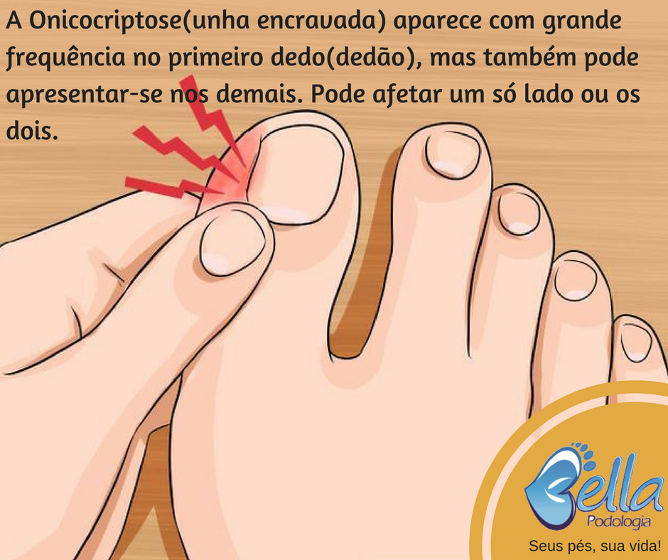 Onicocriptose (unha encravada) :: Bella-podologia